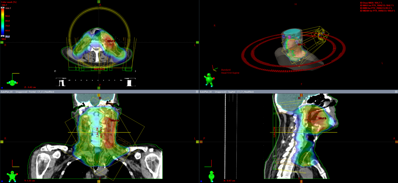 How Radiotherapy Works Raffles Radiotherapy Centre Singapore