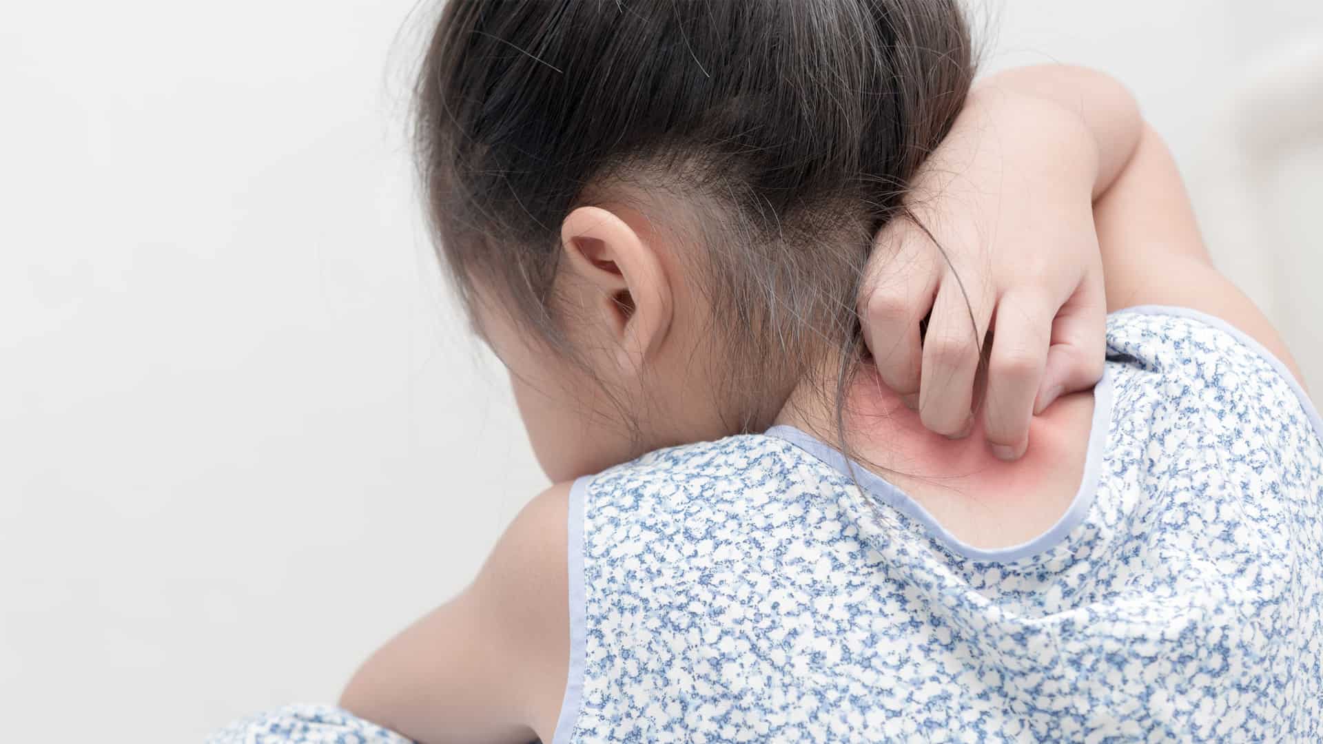 Skin Prick Test for Food Allergy » Raffles Children's Centre, Singapore