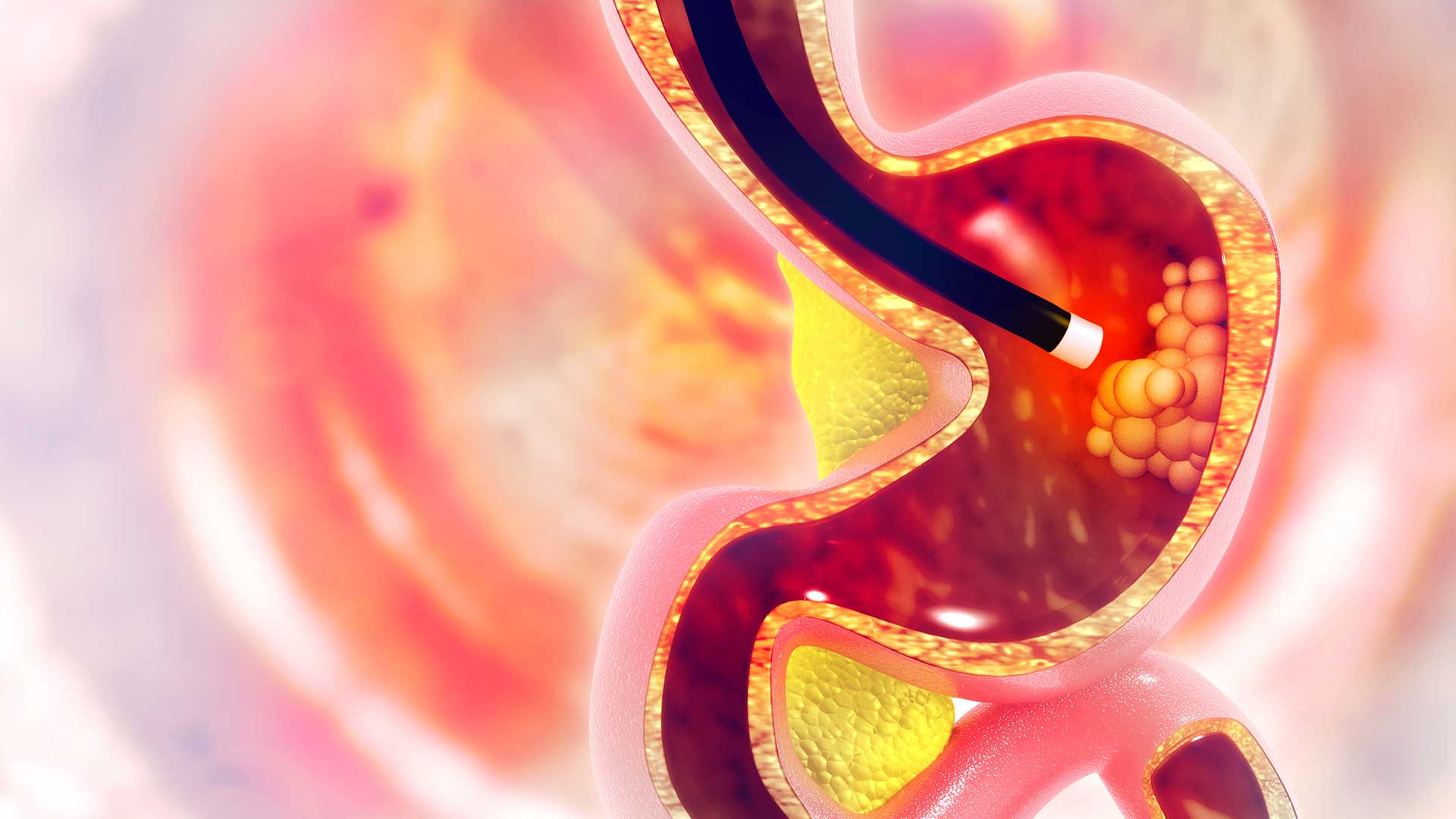 Endoscopy in Singapore » Raffles Internal Medicine Centre