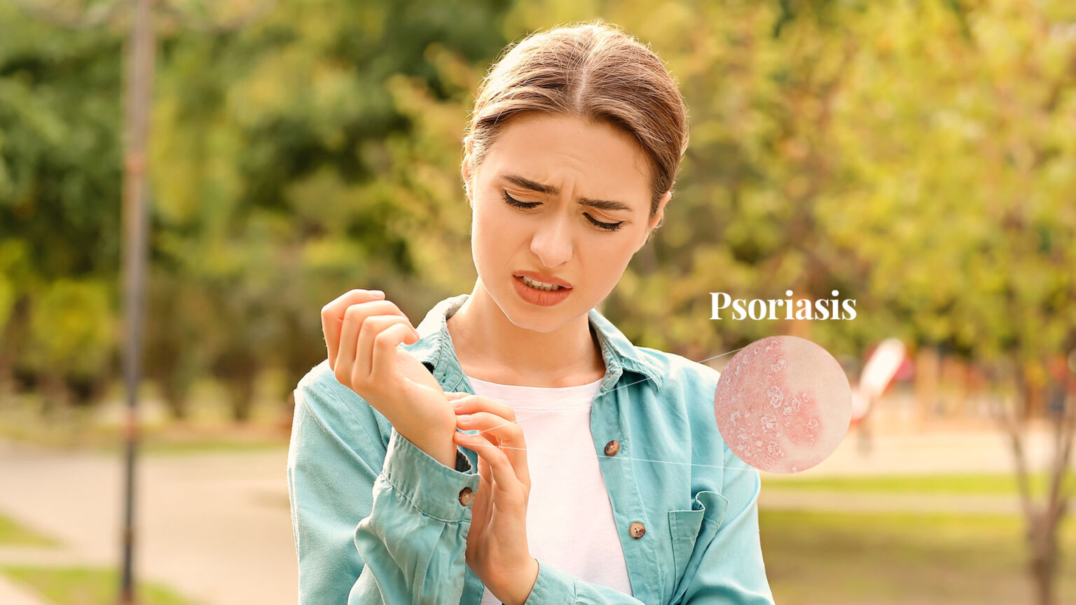 Answering Your Questions About Psoriasis » Raffles Medical Group