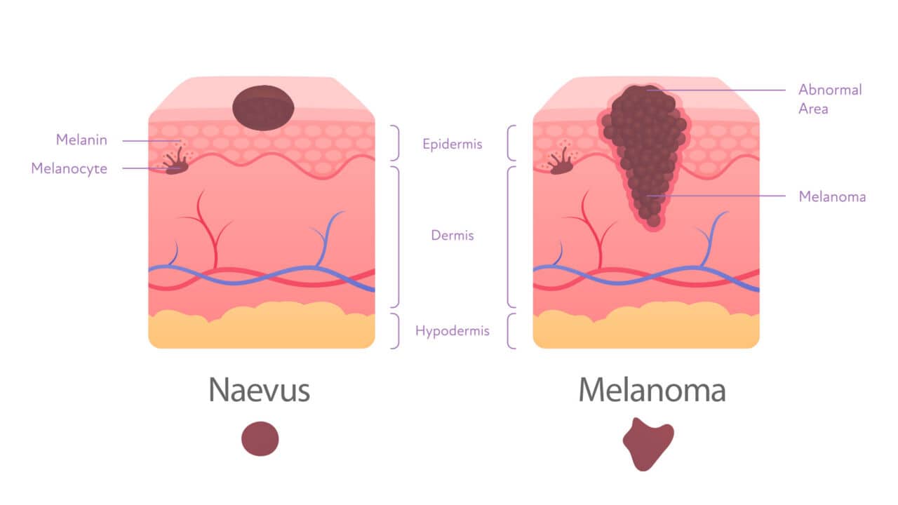 Moles » Raffles Skin & Aesthetics Centre, Singapore