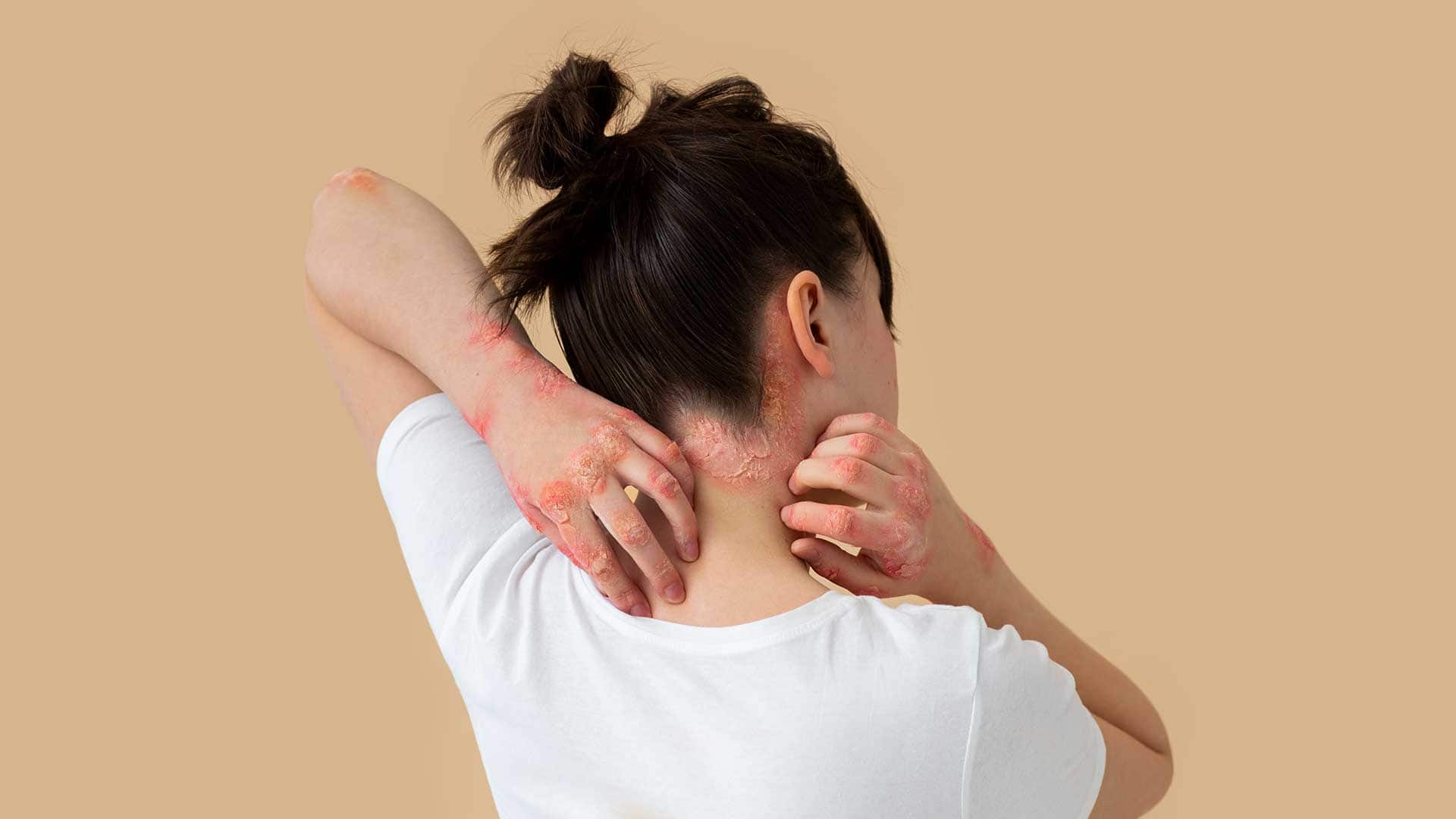 Psoriasis » Treatment » Raffles Skin & Aesthetics Centre, Singapore